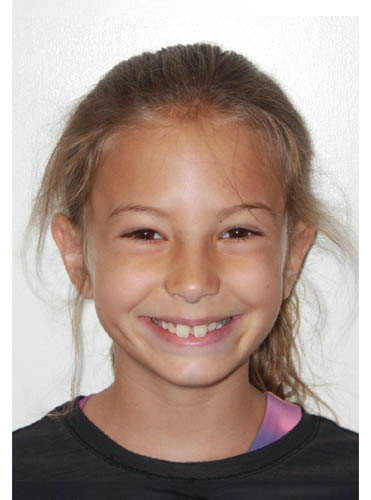 Spark ClearLiners in Westfield, IN | Wittler Orthodontics